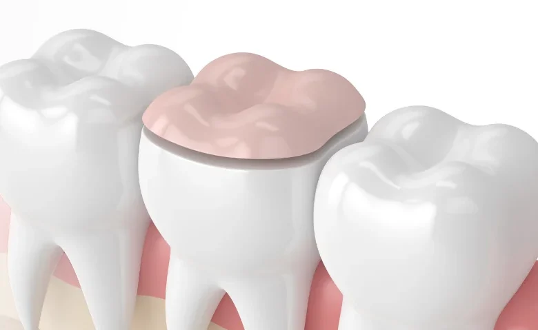 Inlay and Onlay Restorations - Joseph S. Arnold DDS, PC